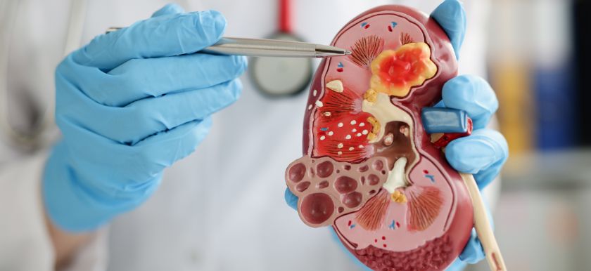 Καρκίνος Νεφρού | Παθολόγος Ογκολόγος, Δρ. Τσιατάς